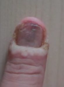 Periungual Warts - Fast Wart Remover