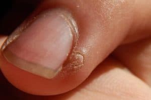 Fingernail & Toenail Warts - Fast Wart Remover